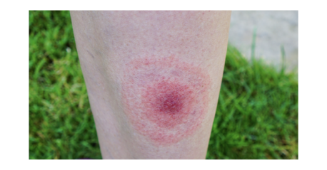 Tick bites explained – Symptoms, Pictures and more | D4L